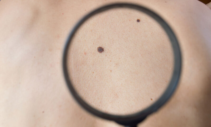 Skin Cancer Awareness Month - Ascend Hospice Care